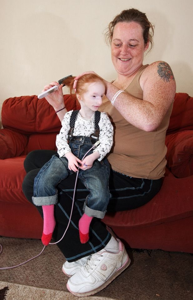 “Nanismo Primordial”: condição rara mantém garotas em baixa estatura ...