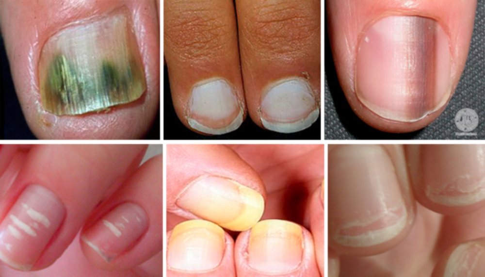 9 dicas para aprender a reconhecer doenças através do aspecto de suas unhas